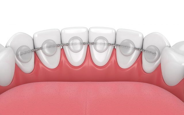 La Importancia de los Retenedores de Ortodoncia - Arce Dental