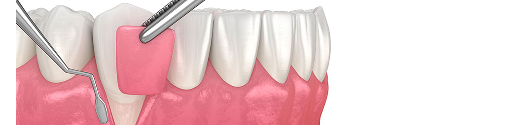 ¿Es posible curar una encía despegada del diente? - Clínica Arce